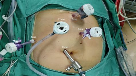Laparoscopic Anatomical Liver Segment Vii Resection With Liver Parenchymal Transection Following