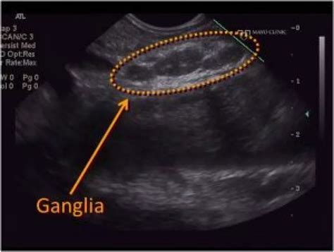 Celiac Plexus Blockneurolysis World Endoscopy Organisation