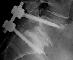 Spinal Fusion Wikipedia
