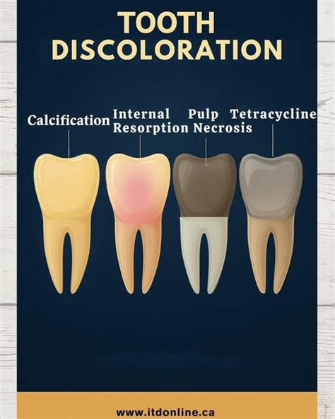 Understanding Tooth Discoloration What The Color Of Your Teeth