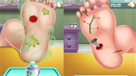 Asmr Treatment Athletes Foot And Warts Between Toes At Home Foot