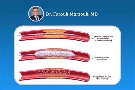 Balloon Angioplasty Vs Stent Key Differences And Benefits