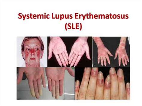 Systemic Lupus Erythematosus Sle Causes Signs And Symptoms