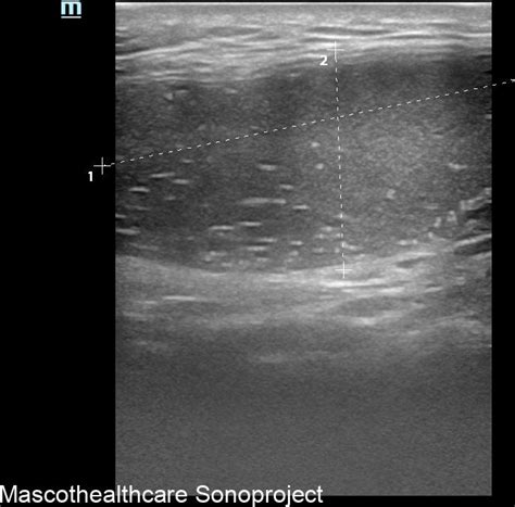 Testicular Microlithiasis Mascot Healthcare Sonoproject