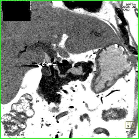Central Intraductal Papillary Mucinous Neoplasm (IPMN) of the Pancreas with Dysplasia and Side ...