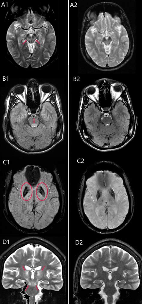 Resolution Of Wing Beating Tremor And Magnetic Resonance Imaging Lesions In Wilsons Disease