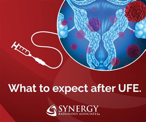 Synergy Radiology On Linkedin Uterine Fibroid Embolization Ufe Is A Minimally Invasive
