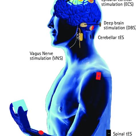 Typical Electrical Stimulation Modalities For Post Stroke Motor Download Scientific Diagram