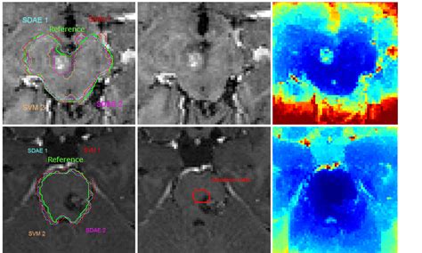 28 Axial Slice Of Brainstem Segmentation With Tumors Causing