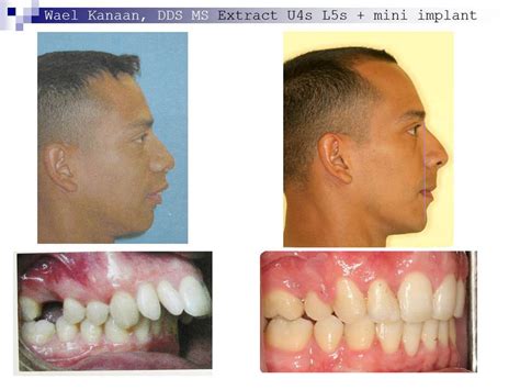 Overbite Correction Houston And Sugarland Tx Ismile