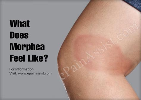 What Does Morphea Feel Like