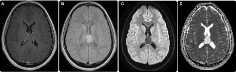 A Unique Finding Of Cavum Velum Interpositum Colloid Like Cyst And Lit