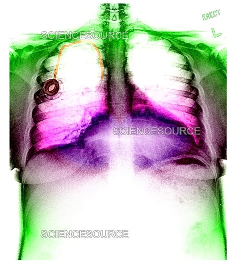 Central Venous Port X Ray Stock Image Science Source Images