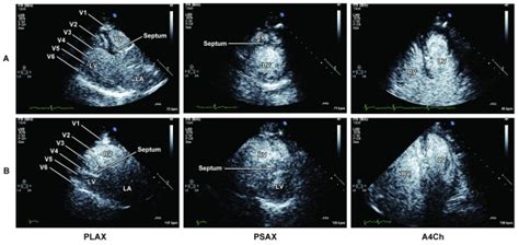 Parasternal Long Axis Plax Parasternal Short Axis Psax And Apical