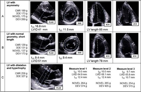 Examples Of Miscalculation By Linear Measurements A Hypertrophic