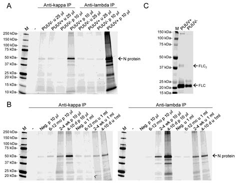 Elevated Kappa And Lambda Light Chains In Urine