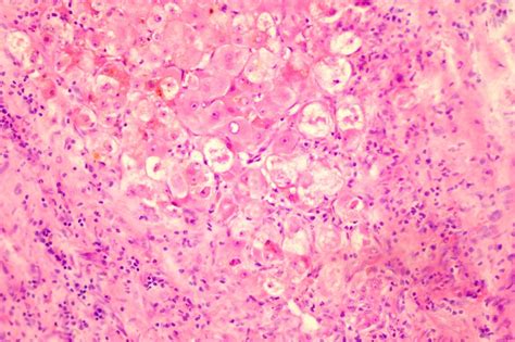病例分享原发性胆汁性胆管炎1例 资讯频道 华夏病理网
