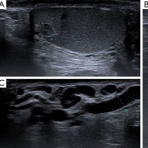 Findings At Ultrasound Imaging Of The Scrotum A 6 Mm Smooth Margin