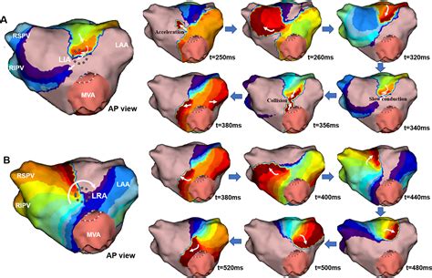 Diverse Activation Patterns During Persistent Atrial Fibrillation By