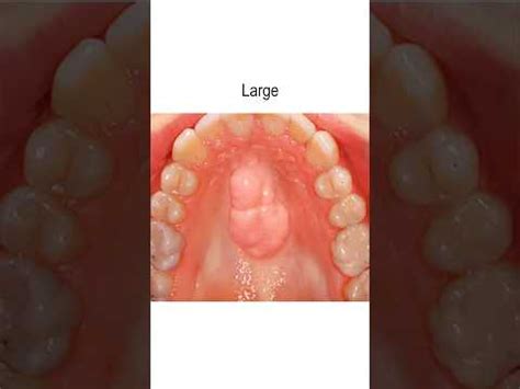 Torus Palatinus Symptoms Causes And Diagnosis Explained Insigh Med