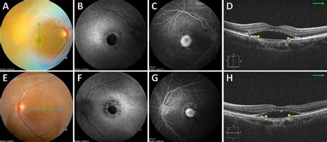 Serous Maculopathy With Absence Of Retinal Pigment Epithelium Smarpe