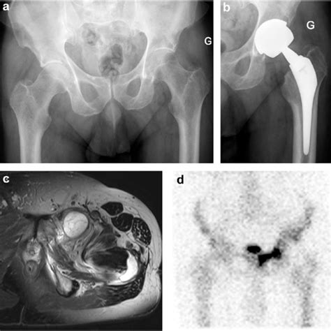 Case 1 Dedifferentiated Chondrosarcoma A Initial Plain Films