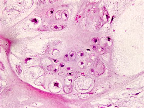 Pathology Outlines Synovial And Tenosynovial Chondromatosis
