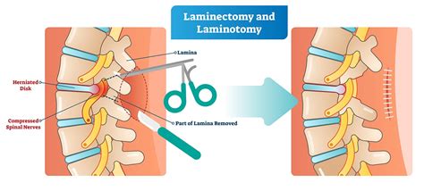 Laminectomy Decompression