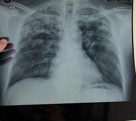 Chest X Ray Showed Infiltrates In Both Lungs Particularly On The