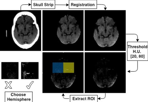 Automated Segmentation For Hyperdense Middle Cerebral Artery Sign Of Acute Ischemic Stroke On