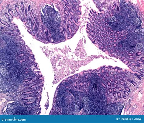 Inflamed Human Appendix Stock Image Image Of Lymphoid 117239643