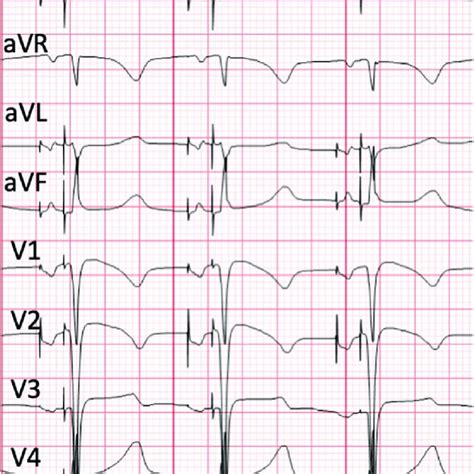 Electrocardiogram Demonstrates Selective His Bundle Pacing 18 Months
