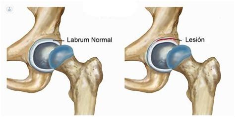 Labrum Glenoideo Posterior Superior Cuál Es El Tratamiento Para Una