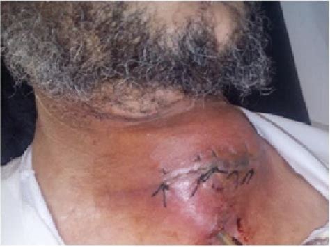 Anterior Cervical Massrecurrent Post Thyroidectomy Hematoma Download Scientific Diagram