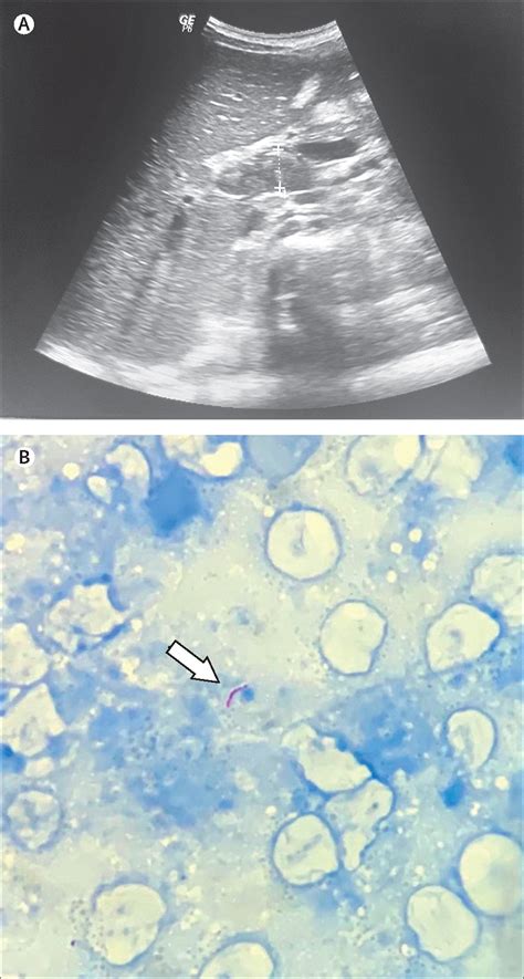 Complexities In The Treatment Of Coinfection With Hiv Hepatitis B