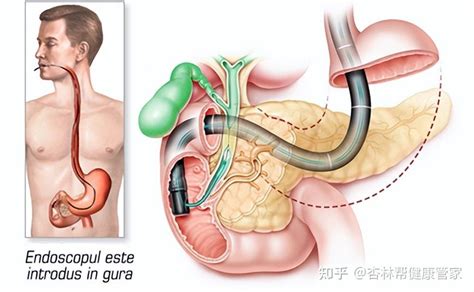 Ercp是什么检查？ 知乎