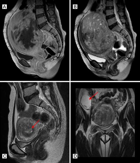 Uterine Fibroids Types