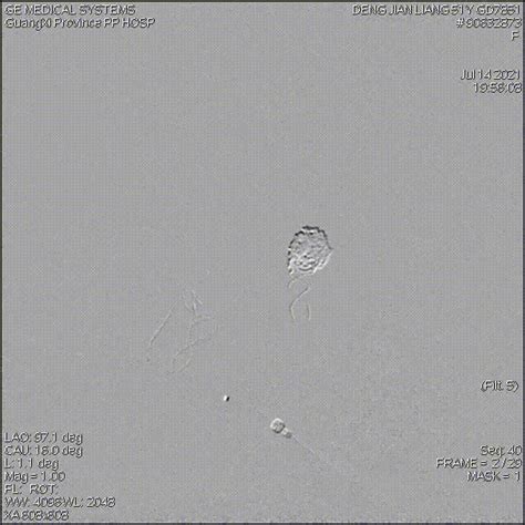 中枢介入第358期：双发动脉瘤适配不同支架辅助治疗 脑医汇 神外资讯 神介资讯