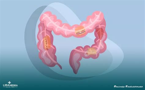 Apa Itu Obstruksi Usus