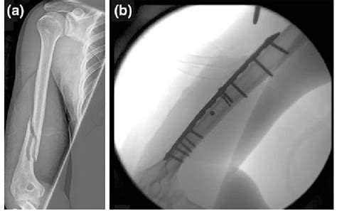 Compression Fracture Arm
