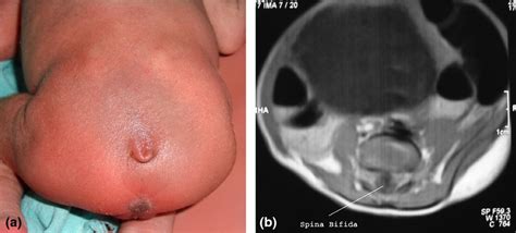 Skin Dimpling Of Hip
