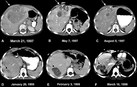 A Four Year Old Female With Hepatoblastoma Of The Left Lobe Treated