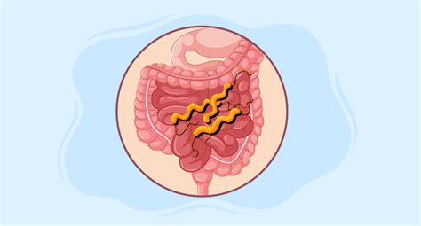 Effective Treatment Strategies For Managing Diphyllobothriasis