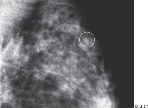 The Evolution Of Casting Type Calcifications Oncohema Key