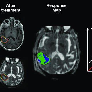 Parametric Response Mapping MRI Is Performed Both Before And After Download Scientific Diagram