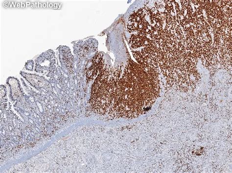 Eatl Immunophenotype Cd7