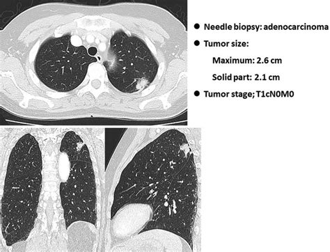 Left S1 2 Segmentectomy By Using Electrocautery Springerlink
