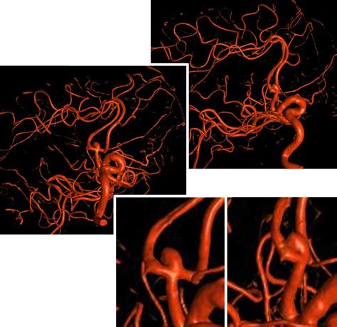 Implantation Of An Artisse™ Intrasaccular Device For An Incidental Acom Aneurysm