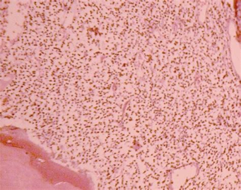 Severe Inflammation 2 Months After Pulpotomy With Formocresol H And E×