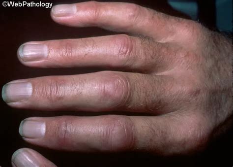Dermatomyositis